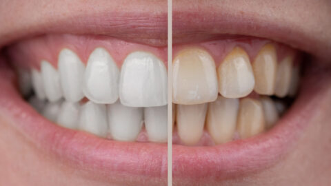 Causes and Solutions for Different Types of Teeth Stains - Annex Dentistry