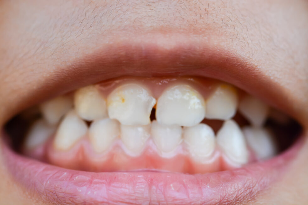 Chipped Tooth Repair: What to Do If You Have a Chipped Tooth - Annex ...
